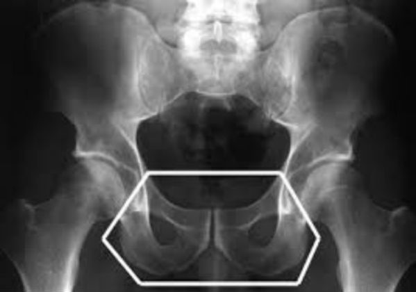 What Causes Pain in the Upper Thigh and Groin Area? Bad News...